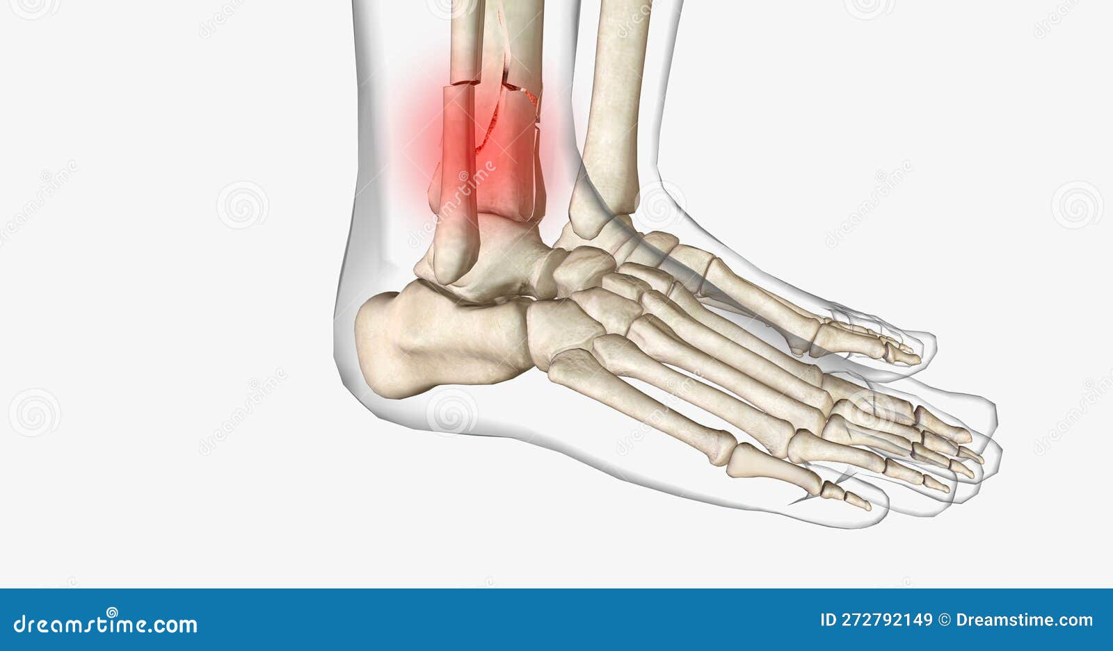 Ankle Fracture And Right Foot Anterior Trauma Medical View Outline ...