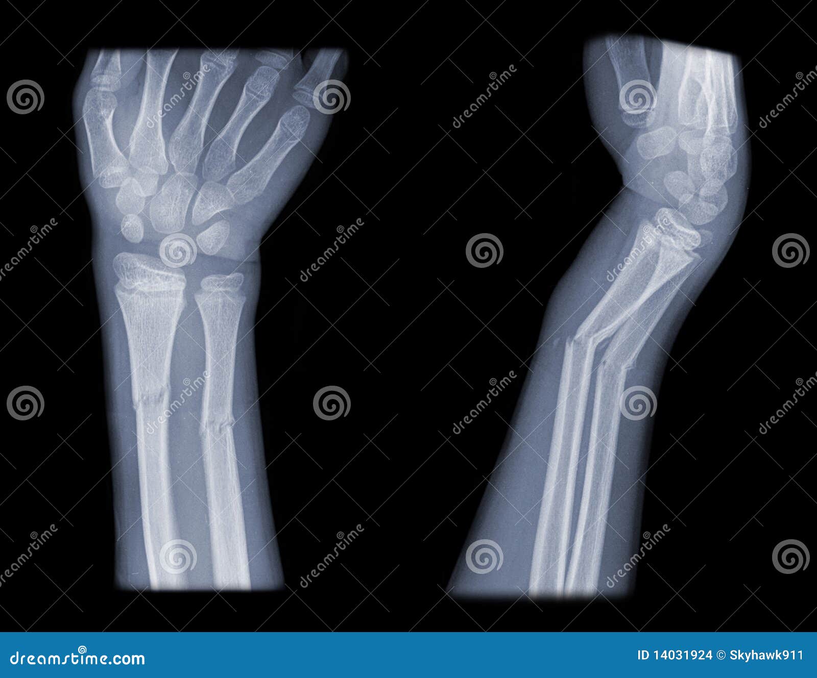 Distaler Armbruch stockfoto. Bild von diagnose, obacht - 14031924
