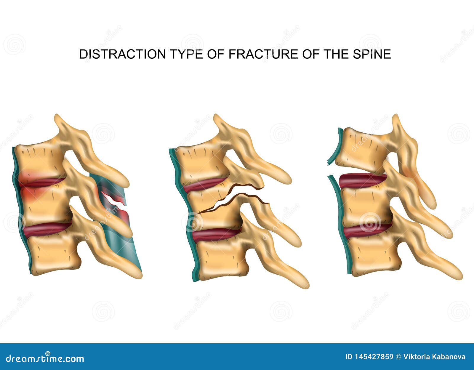 Distraction Type of Fracture of the Spine Stock Vector - Illustration ... Distraction Type of Fracture of the Spine Stock Vector - Illustration ...