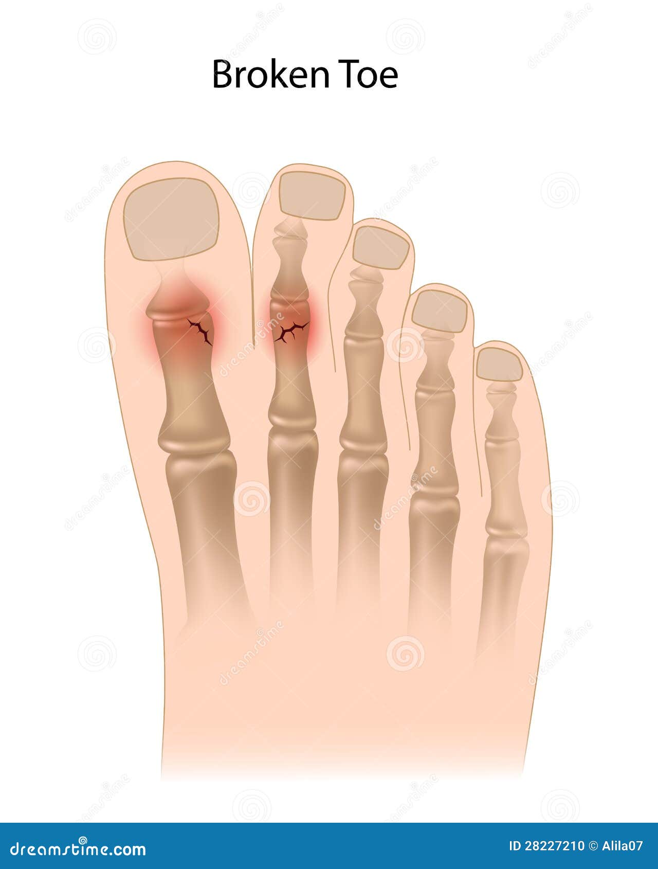 Dito del piede rotto illustrazione vettoriale. Illustrazione di falanx ...