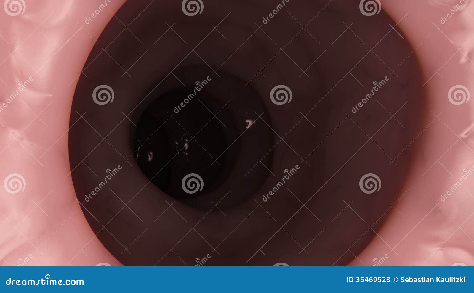 Diverticle from Inside the Colon Stock Footage - Video of ...