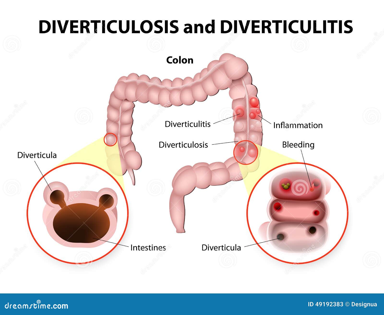 Diverticolosi E Diverticolite Illustrazione Vettoriale - Illustrazione ...