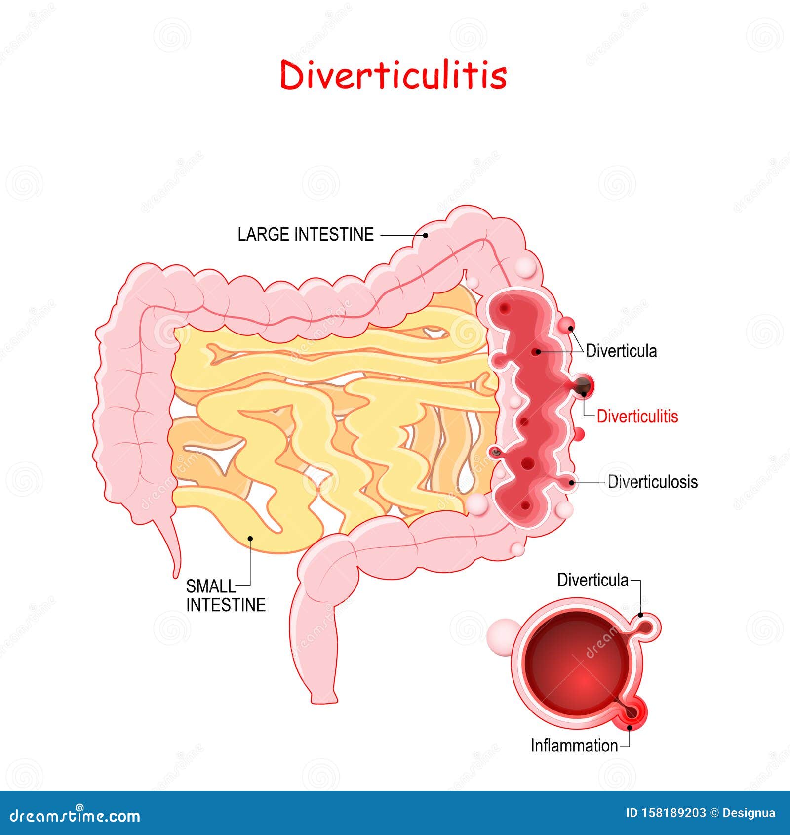 Diverticulosis Y Diverticulitis Ilustración del Vector - Ilustración de ...