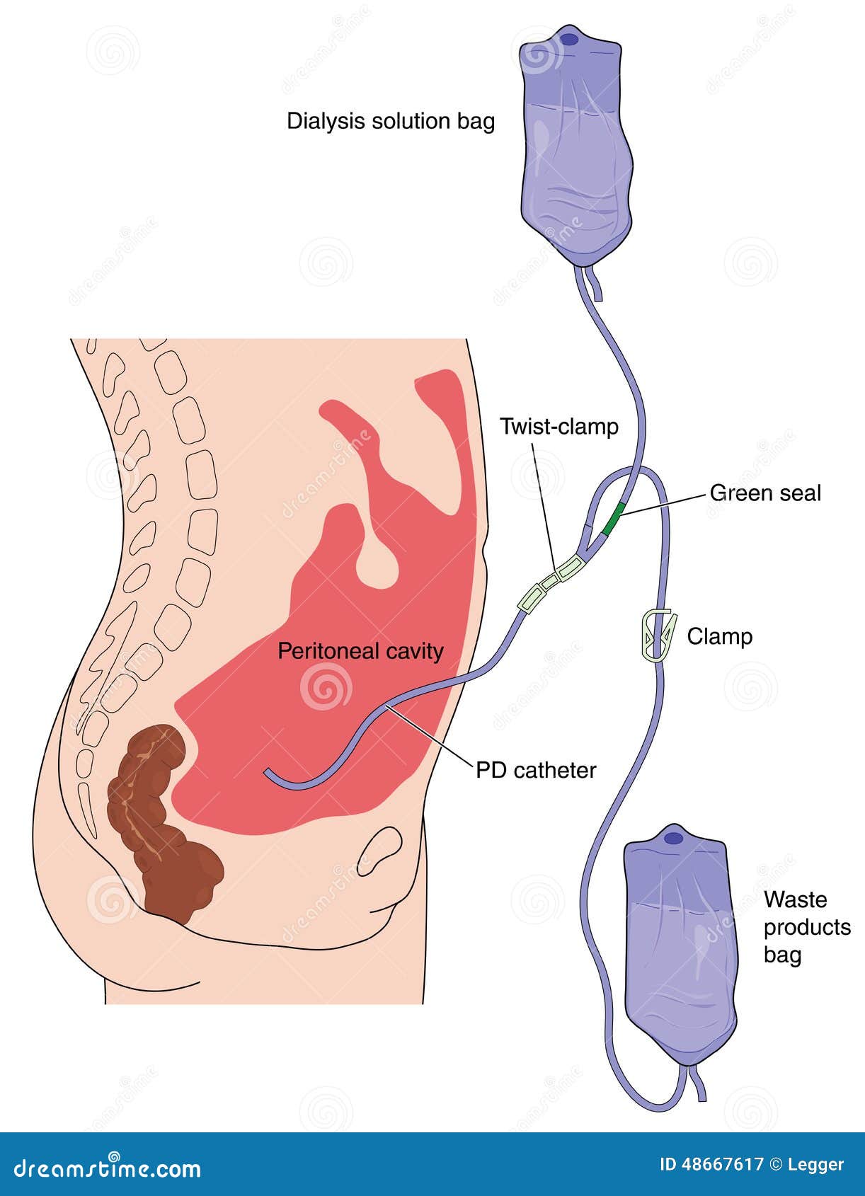 Diálisis peritoneal ilustración del vector. Ilustración de peritoneal - 48667617