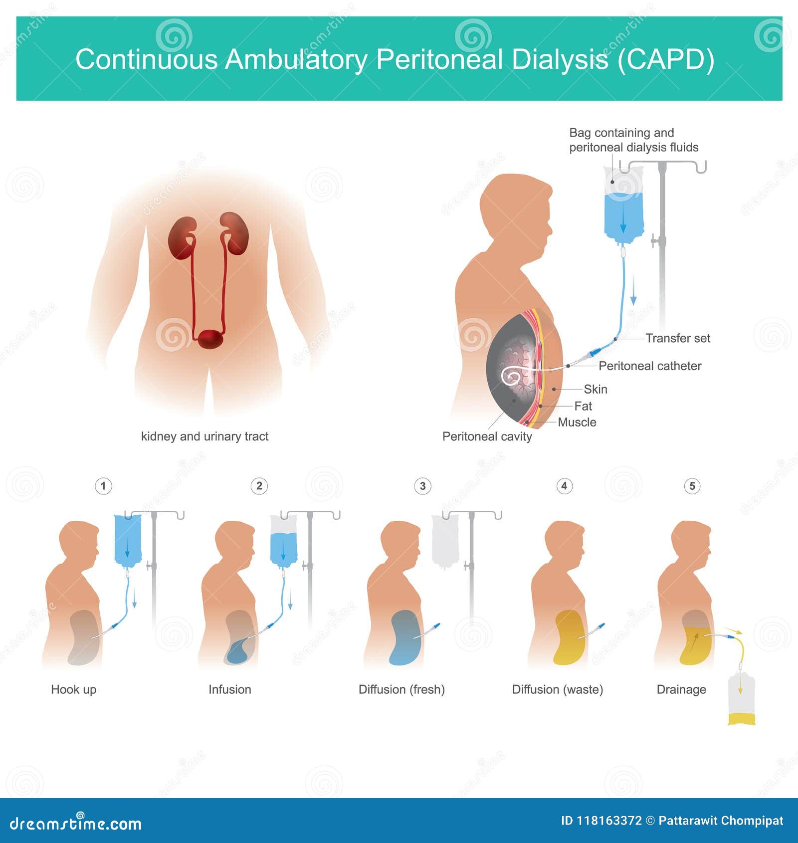 Diálisis Peritoneal Ambulativa Continua CAPD Stock de ilustración - Ilustración de bolso ...