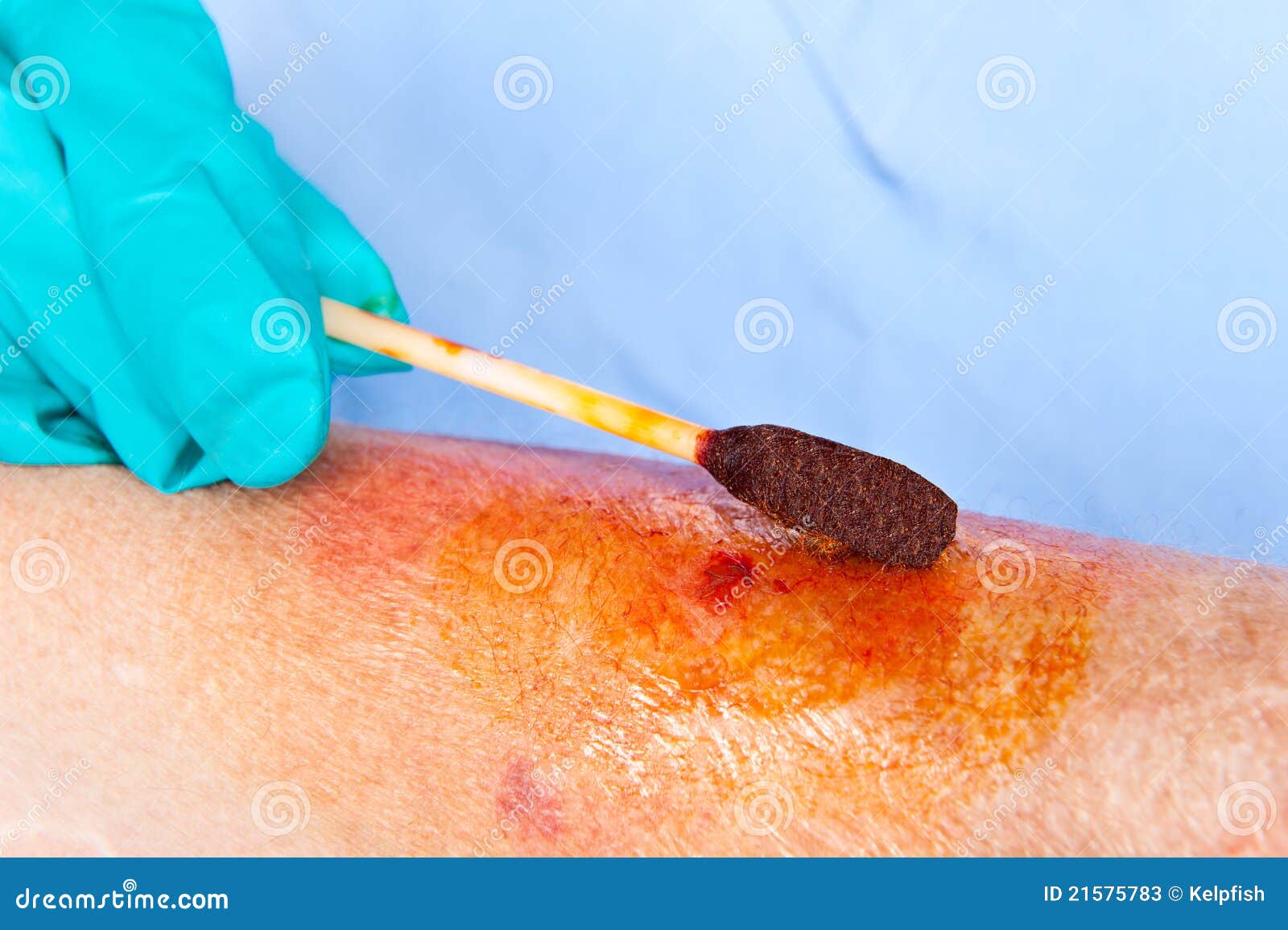 Doctor cleaning wound stock image. Image of clean, skin - 21575783