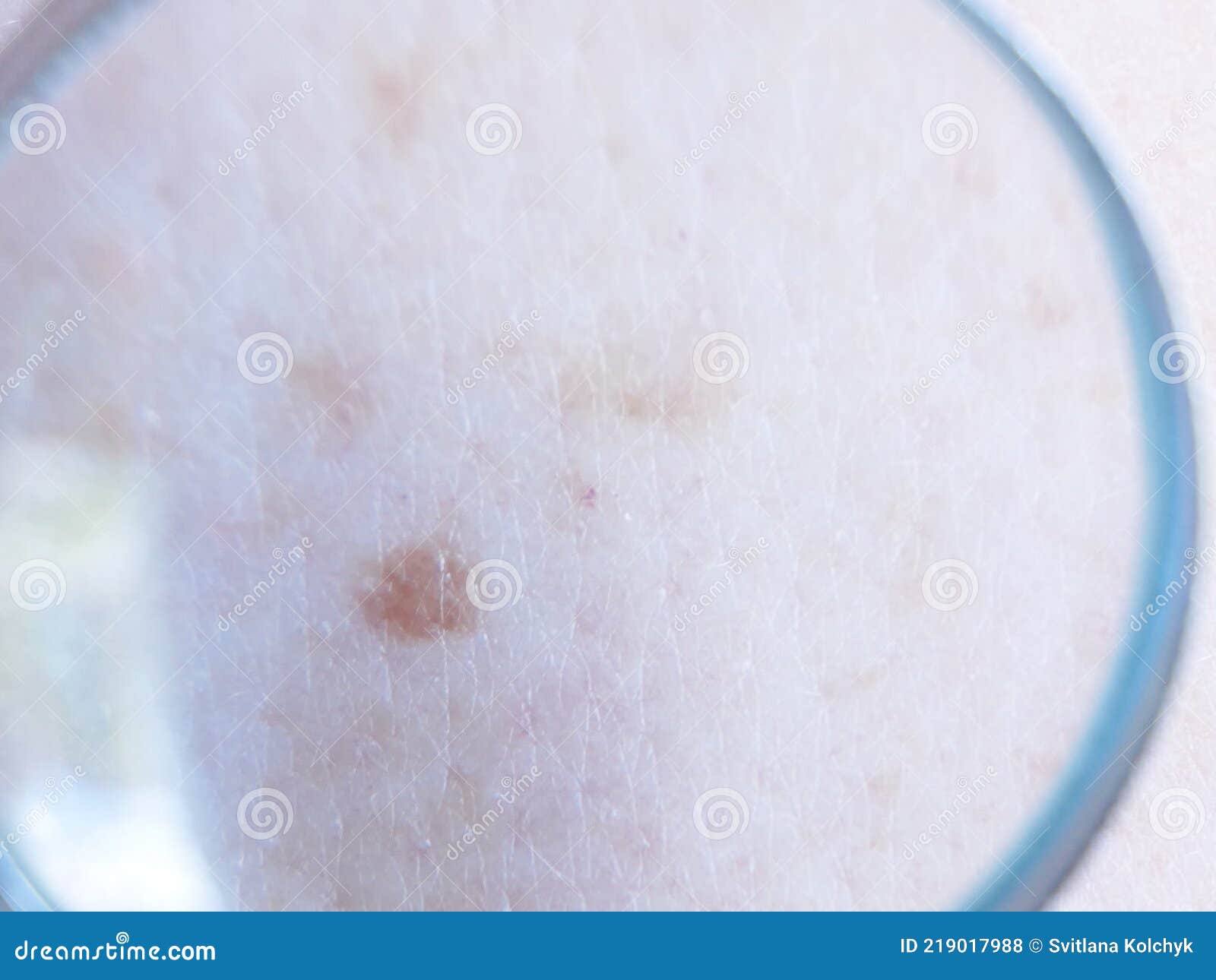 Doctor Dermatologist Examines Birthmark Of Patient Checking Benign