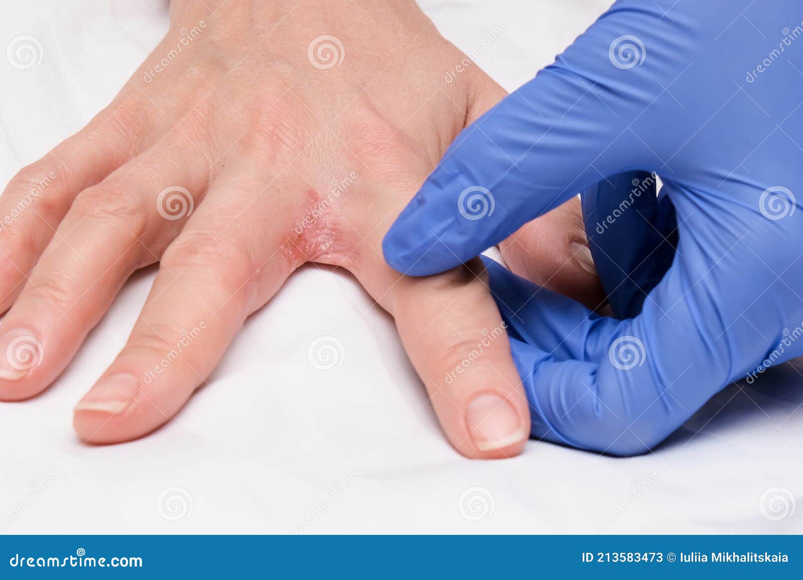 A Doctor Dermatologist Examines Patients Hand with Interdigital ...