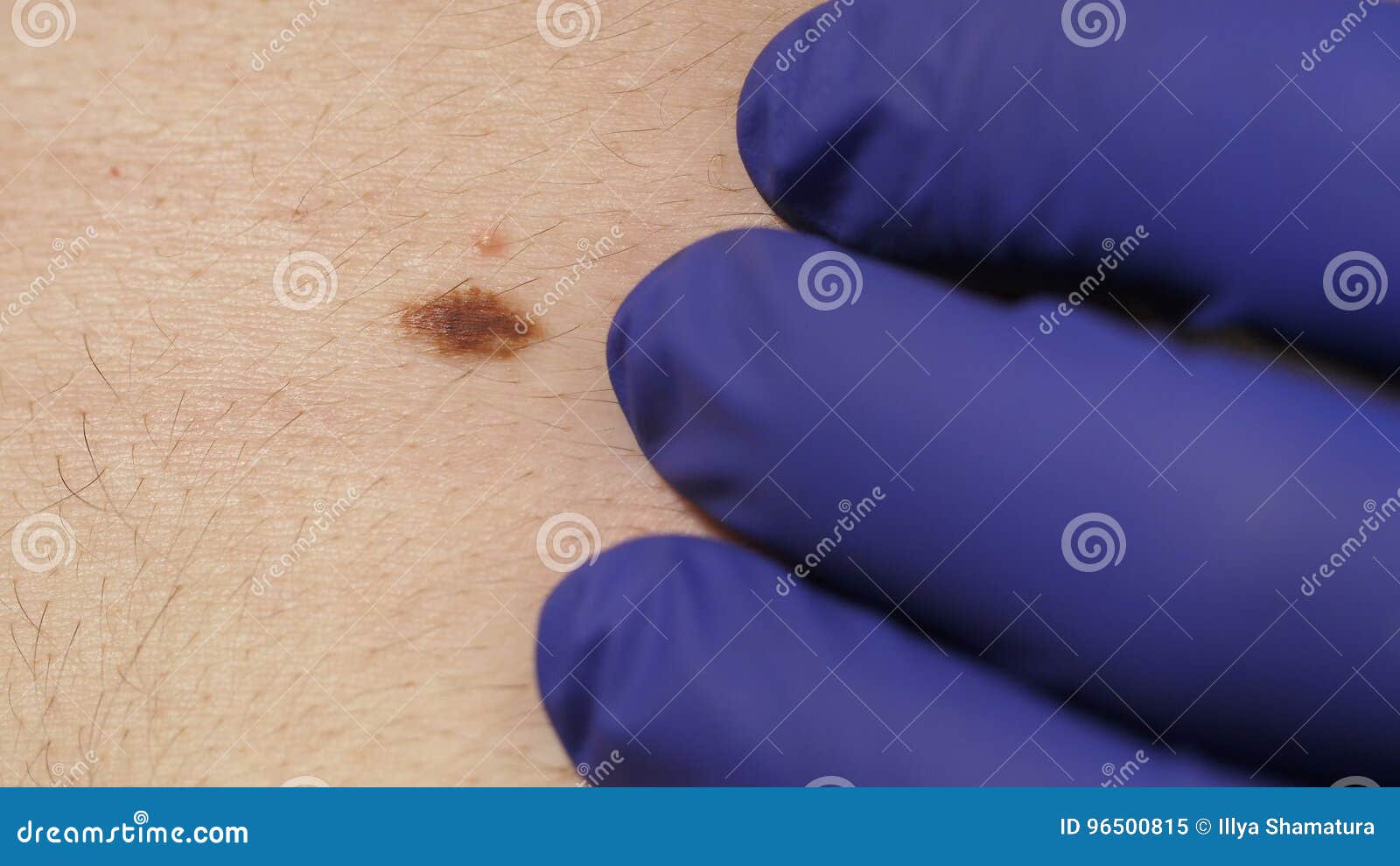 Doctor Examines Birthmark Of Patient Stock Video Video Of