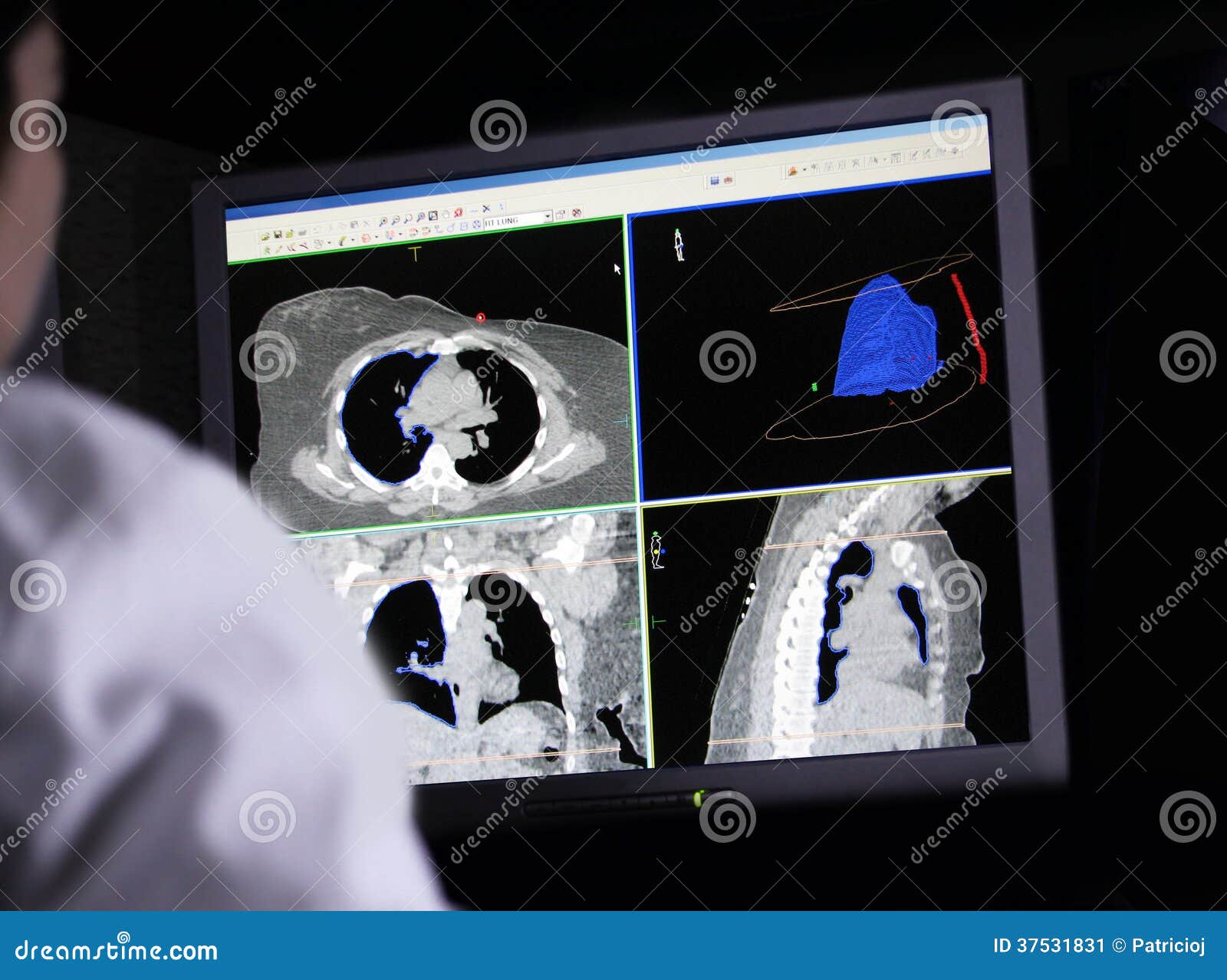 Doctor Examining a Lung Scan on Computer Stock Image - Image of chest ...