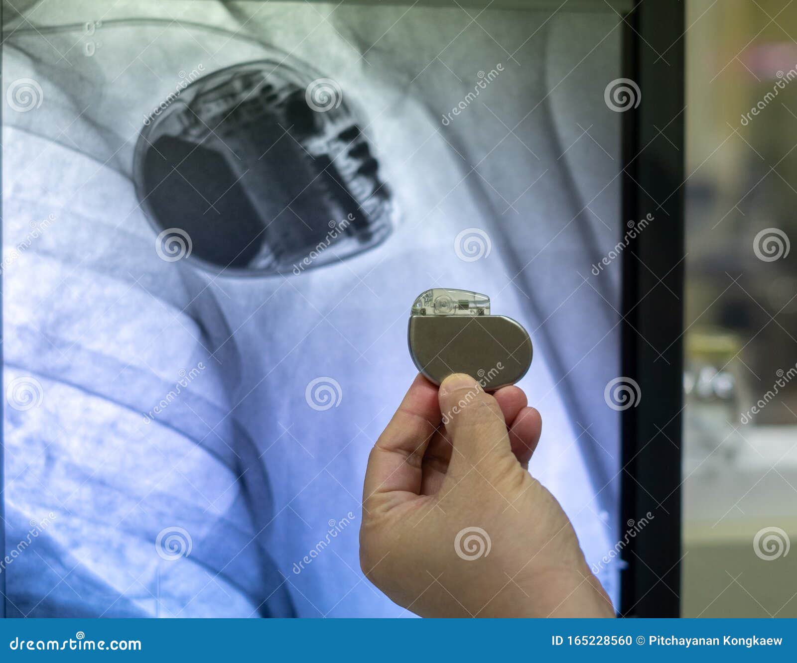 Pacemaker Showing In Chest X-ray Stock Image | CartoonDealer.com #134286589