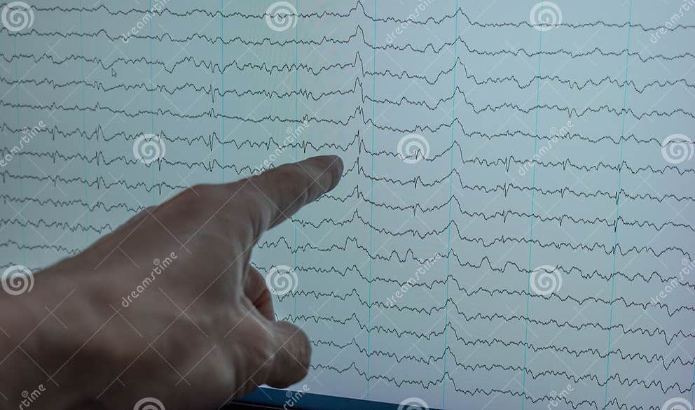 Doctor Hand Pointing at EEG Graph on Computer Screen Stock Image ...