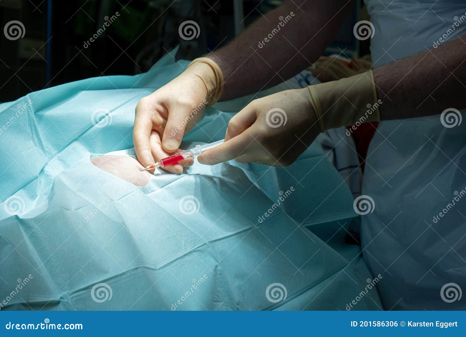 Doctor Performs a Knee Puncture in an Operating Room with a Cannula and ...