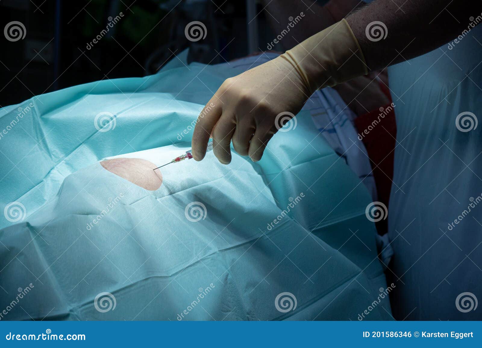 Doctor Performs a Knee Puncture in an Operating Room with a Cannula and ...