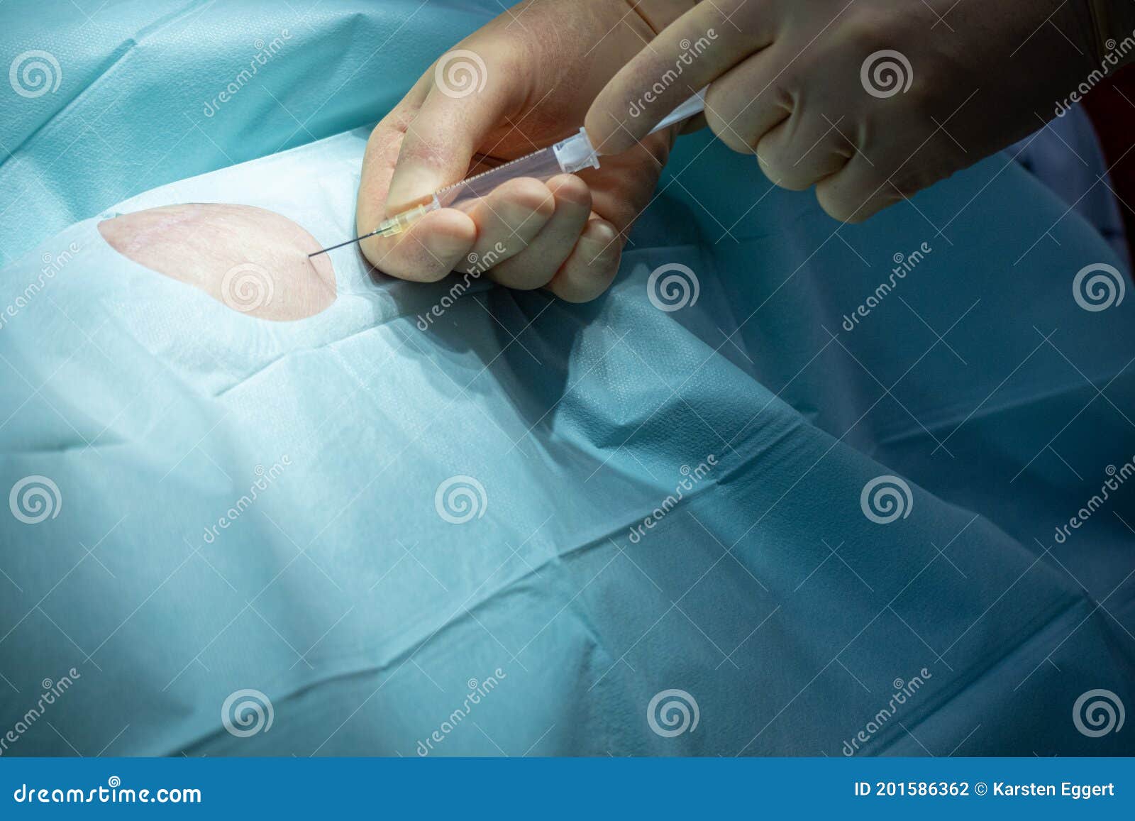 Doctor Performs a Knee Puncture in an Operating Room with a Cannula and ...