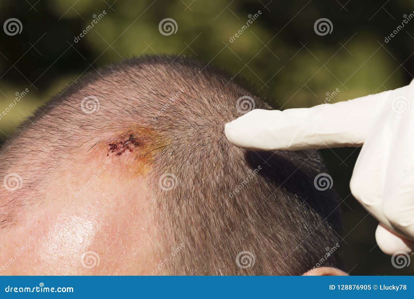 Doctor Pointing on Scar after Remove Stitches Stock Image - Image of ...