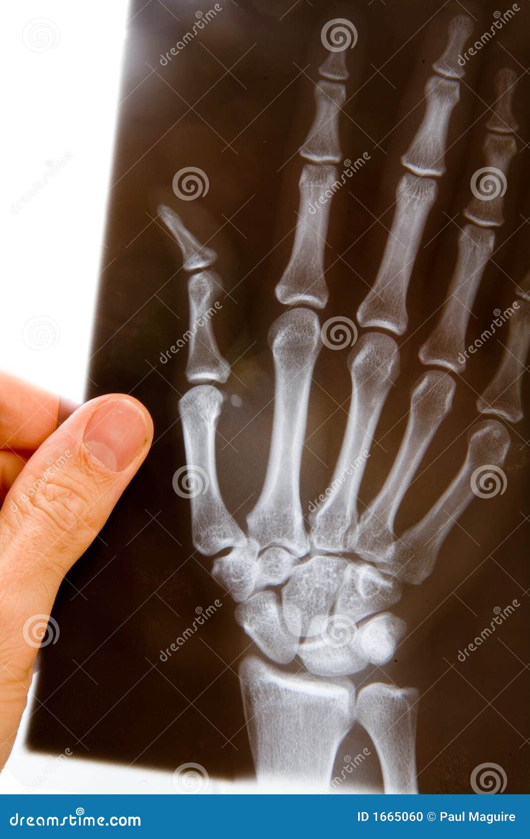 Doctor with x-ray of hand stock photo. Image of analysing - 1665060