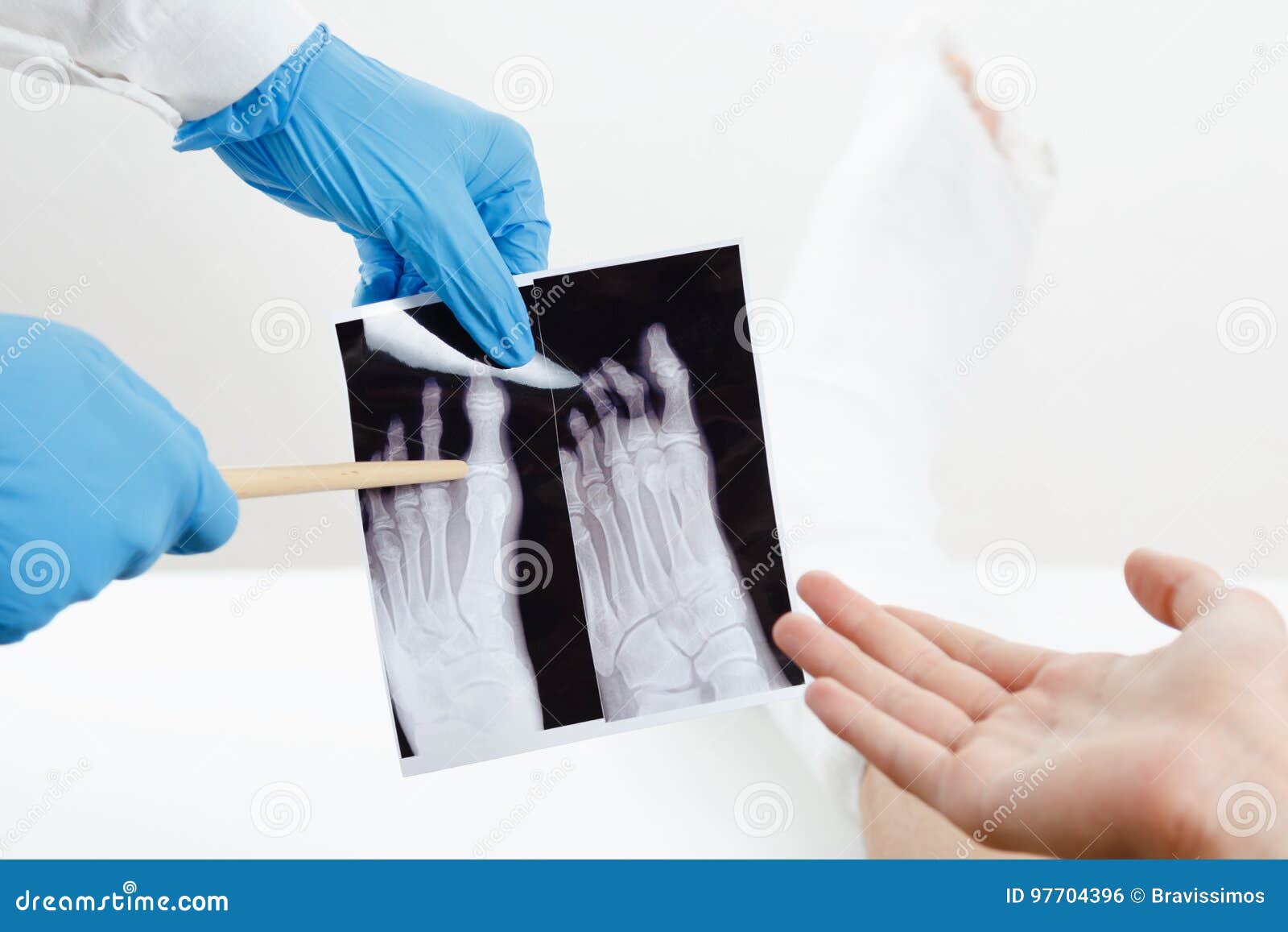 Doctor Showing Patient X-ray Image of a Broken Finger Leg in Plaster ...