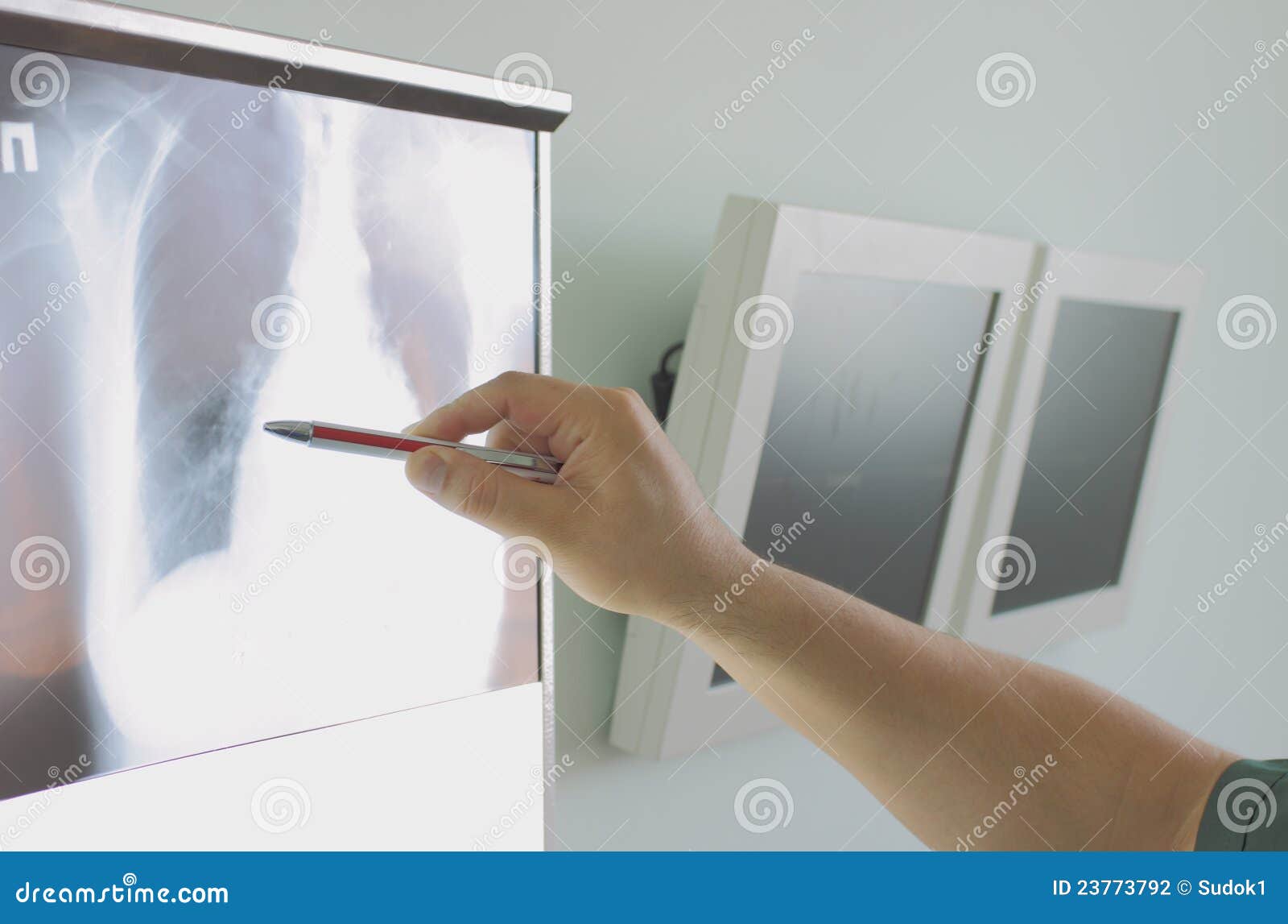 Doctor Shows To Area on Roentgenogram. Stock Photo - Image of lungs ...