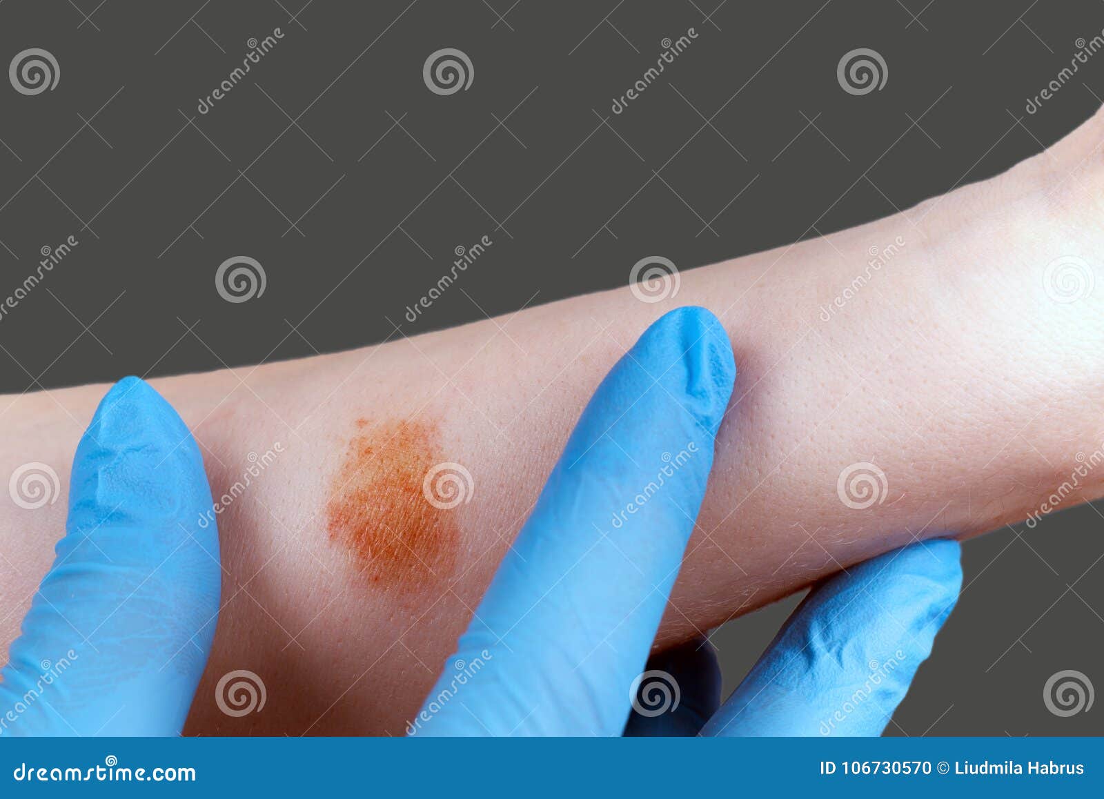 The Doctor Spends Examining an Allergic Rash of Patient Stock Photo ...