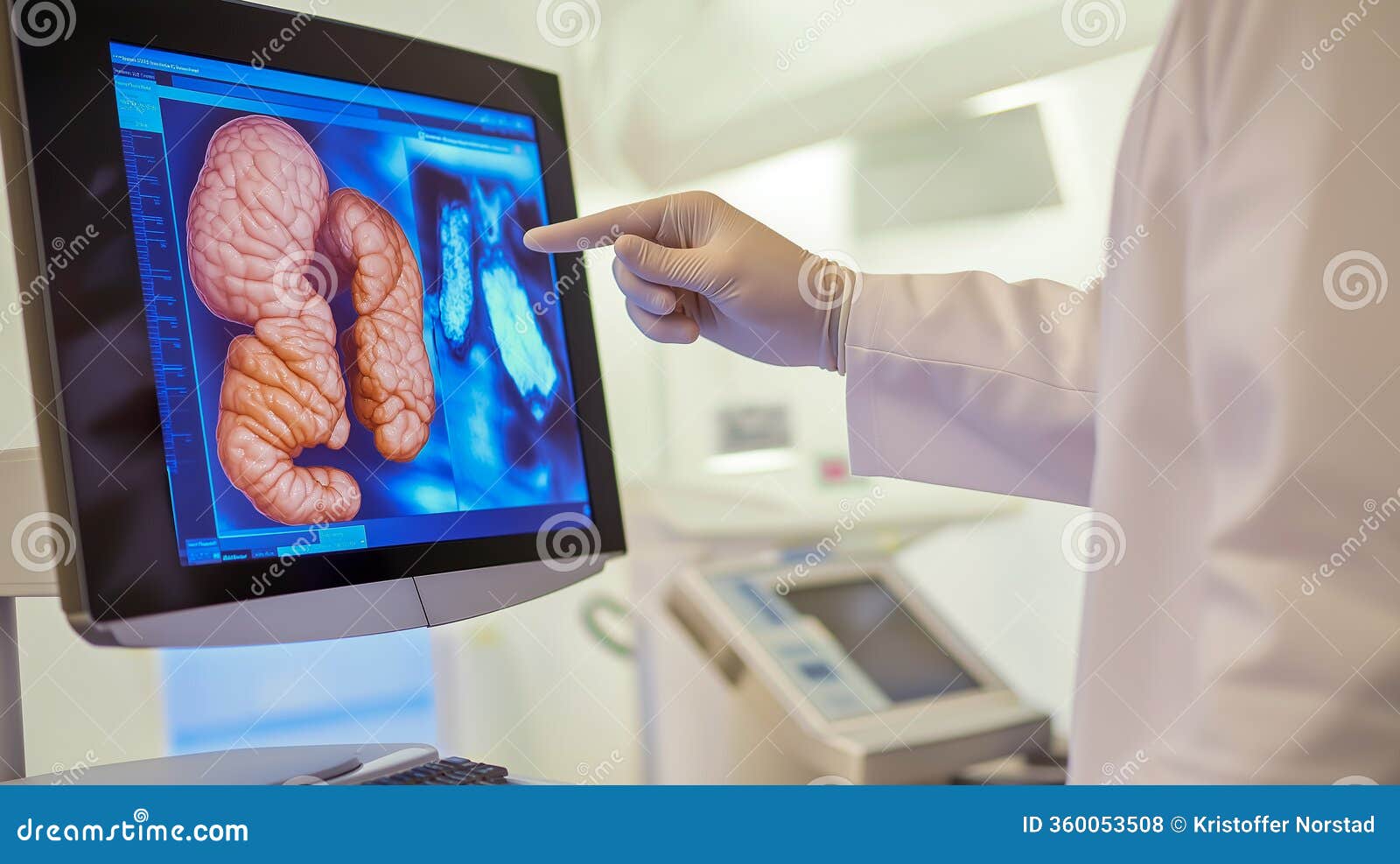 Bowel Polyps, Colorectal Polyps, 3D Illustration | CartoonDealer.com ...