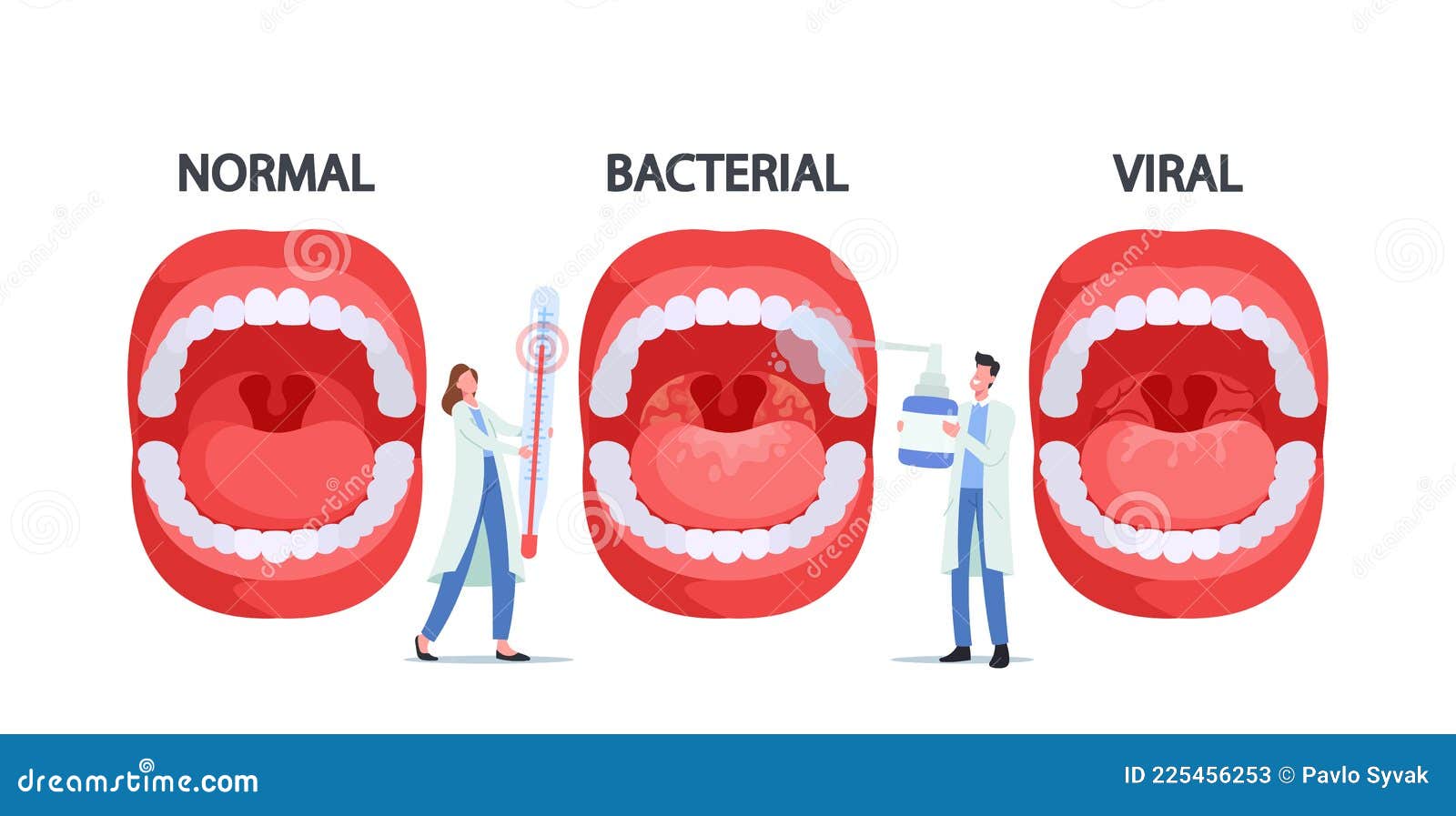 Bacterial Vs Viral Pharyngitis
