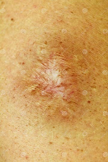 Dog Bite Scar stock photo. Image of stitches, wound, medicine - 21044966