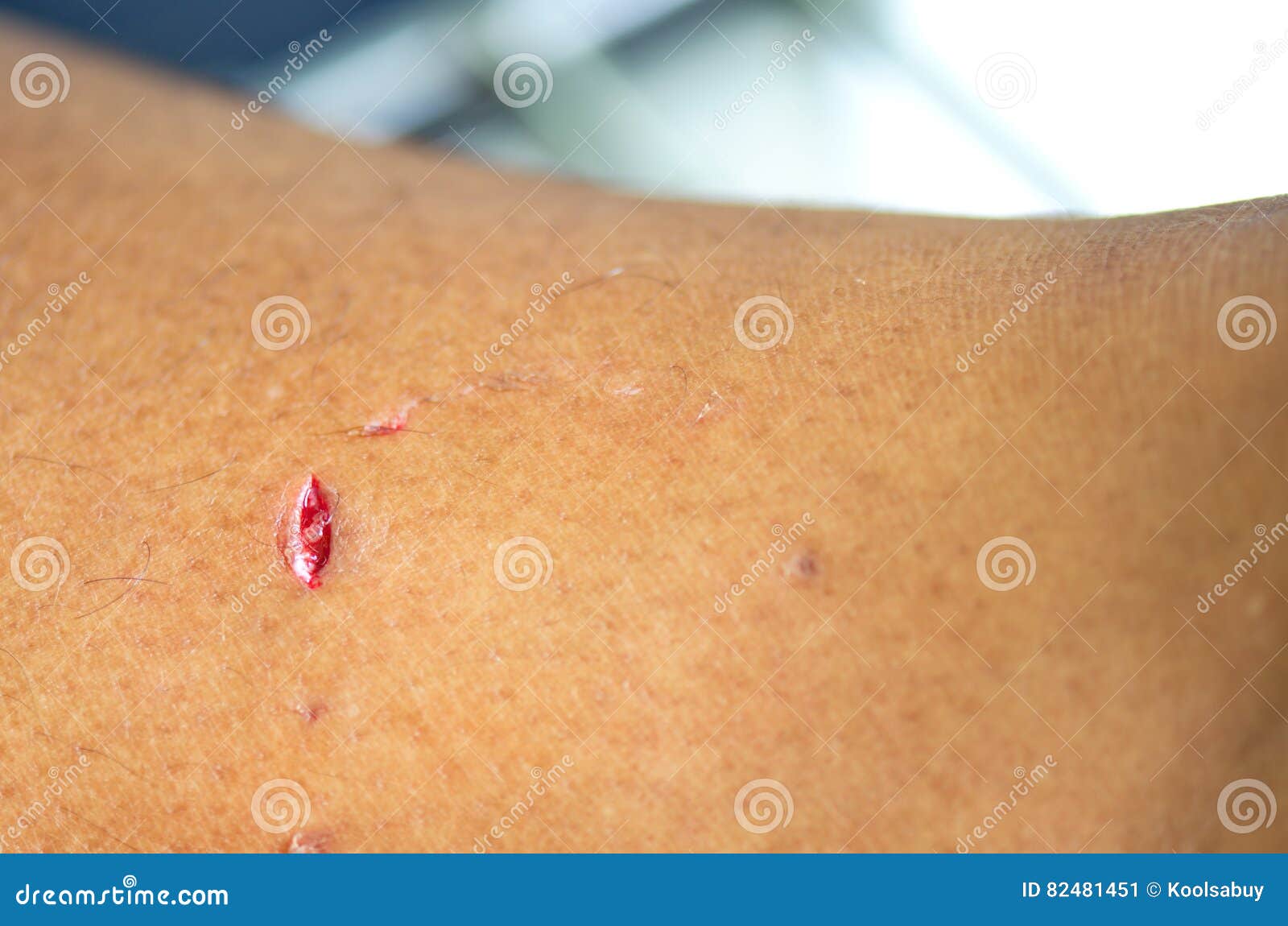 Dog bite wound. stock image. Image of hygiene, injury - 82481451
