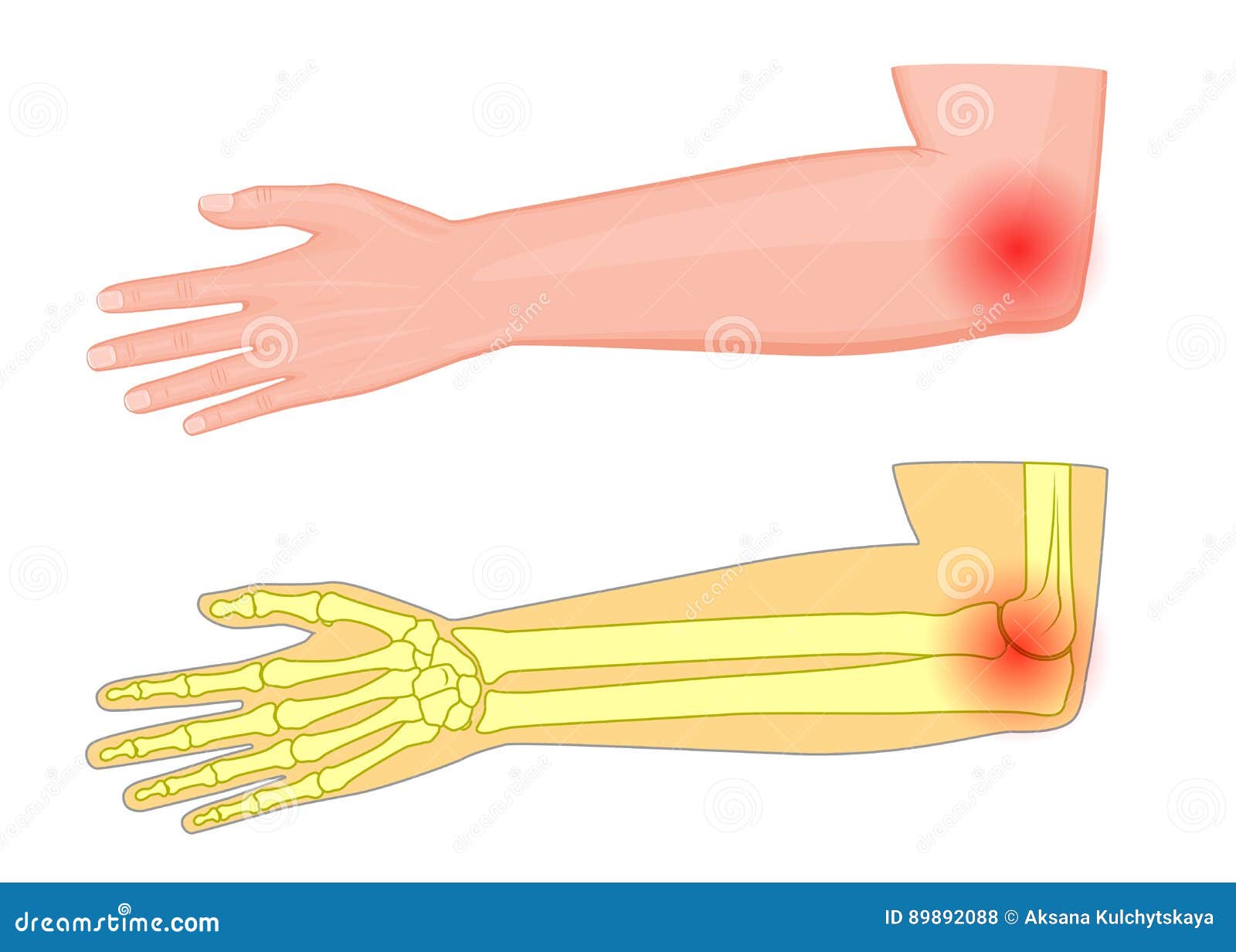 Dolor común de codo ilustración del vector. Ilustración de radio - 89892088