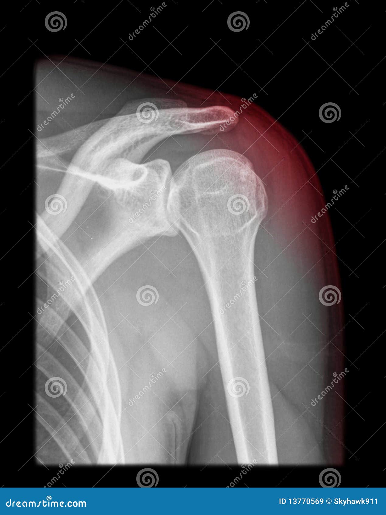 Hombro Normal De Rayos X