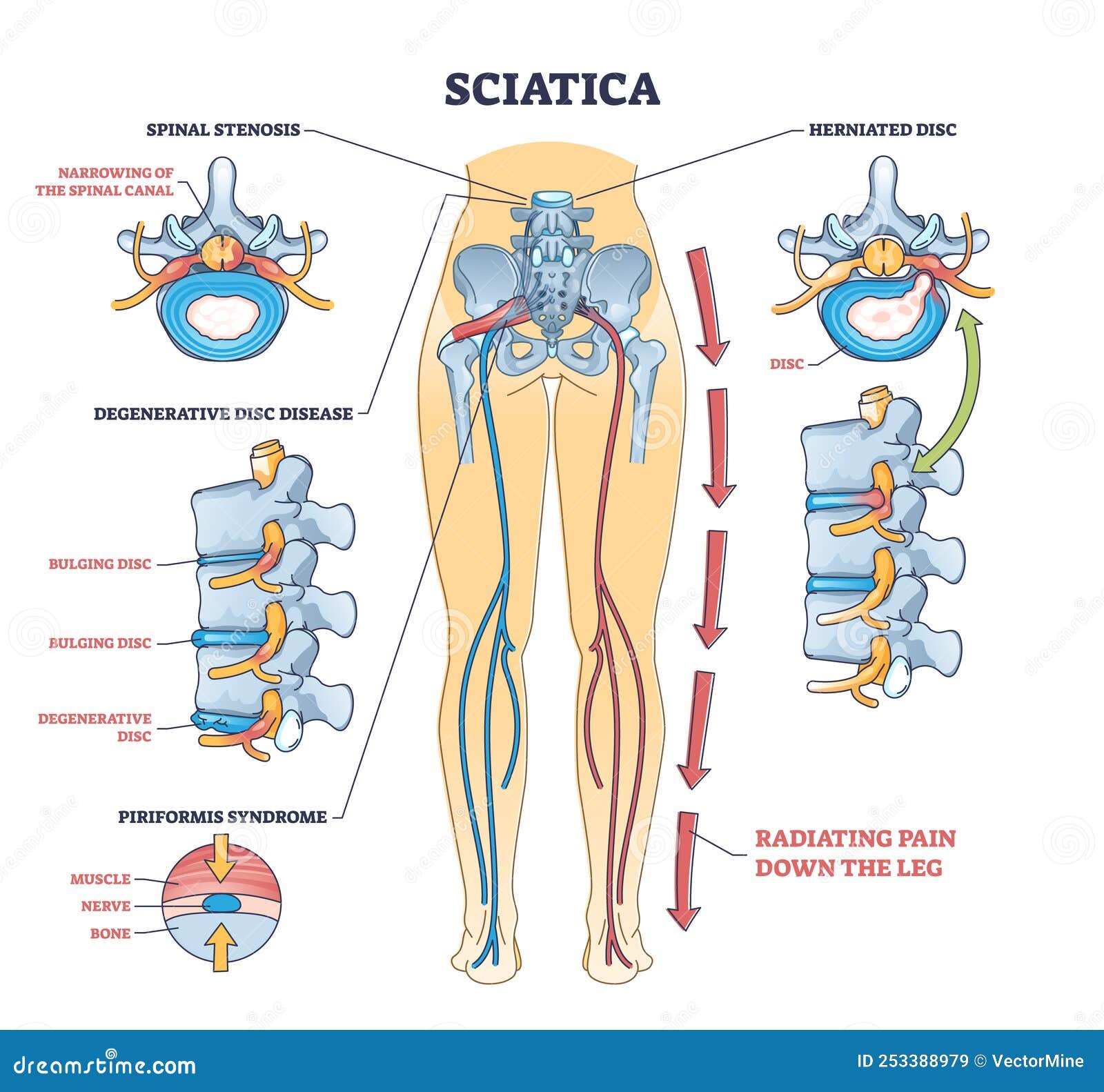 Dor Ou Fraqueza Nervosa Ciática Como Diagrama Esquemático Da