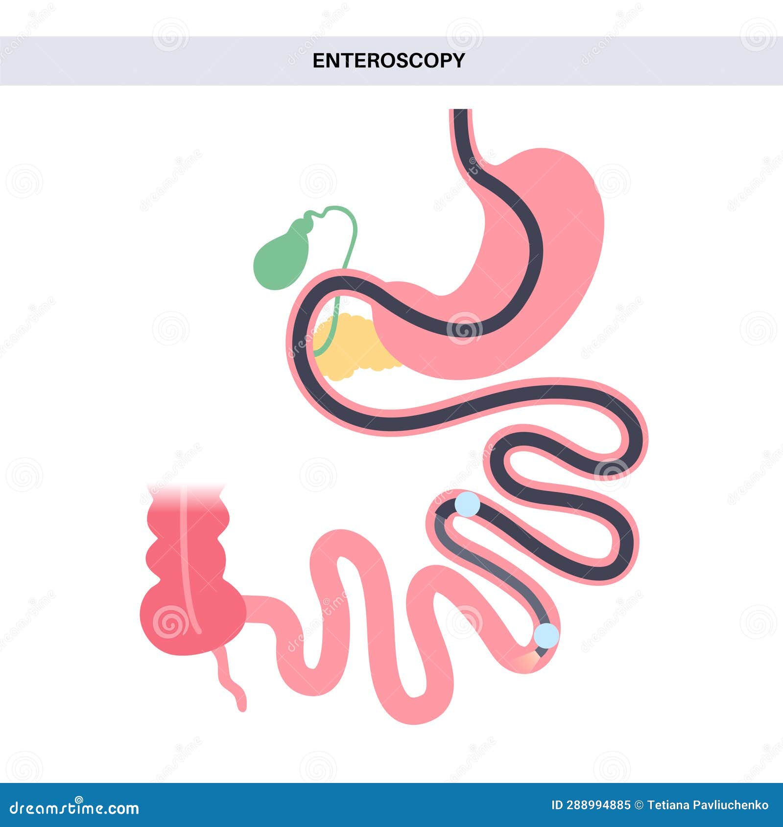 Double balloon enteroscopy stock illustration. Illustration of ...