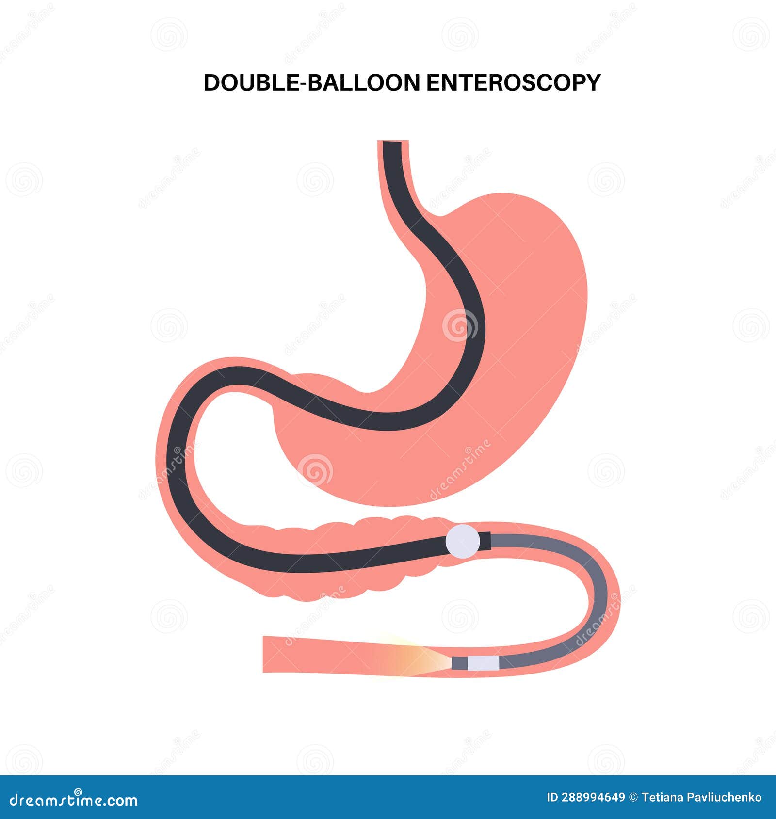 Double balloon enteroscopy stock illustration. Illustration of ...