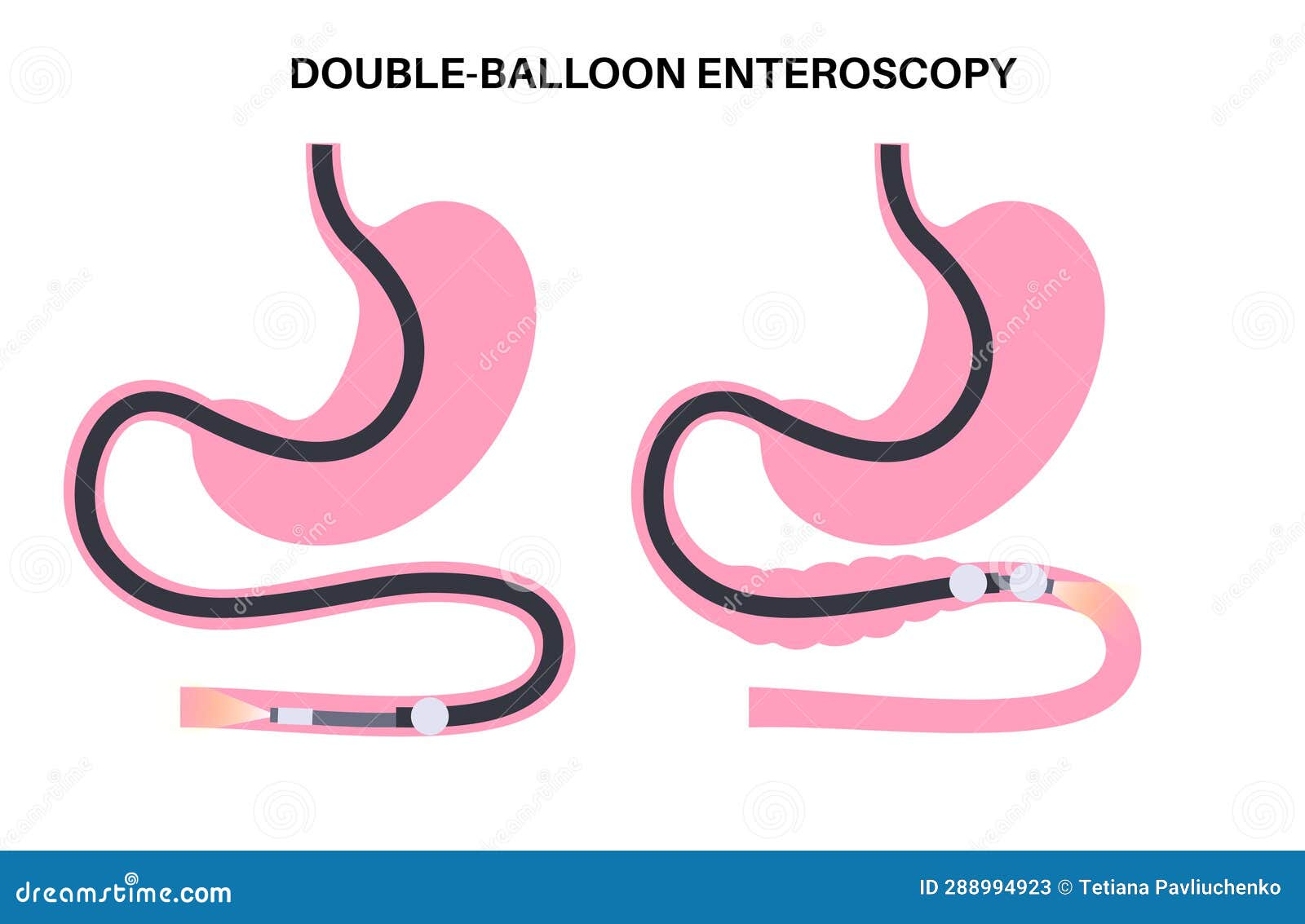 Double balloon enteroscopy stock illustration. Illustration of duodenum ...
