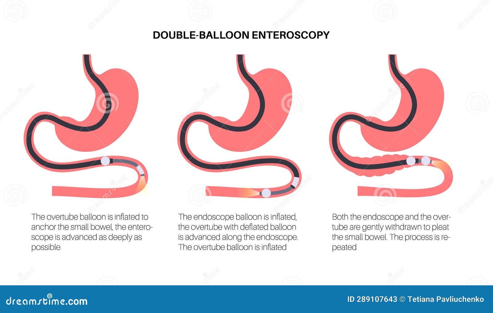 Double balloon enteroscopy stock vector. Illustration of nonsurgical ...
