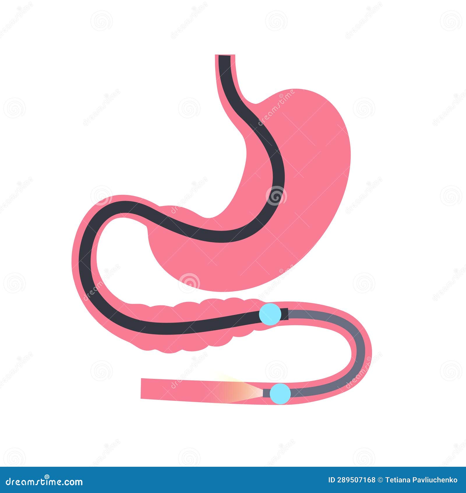 Double balloon enteroscopy stock vector. Illustration of treatment ...