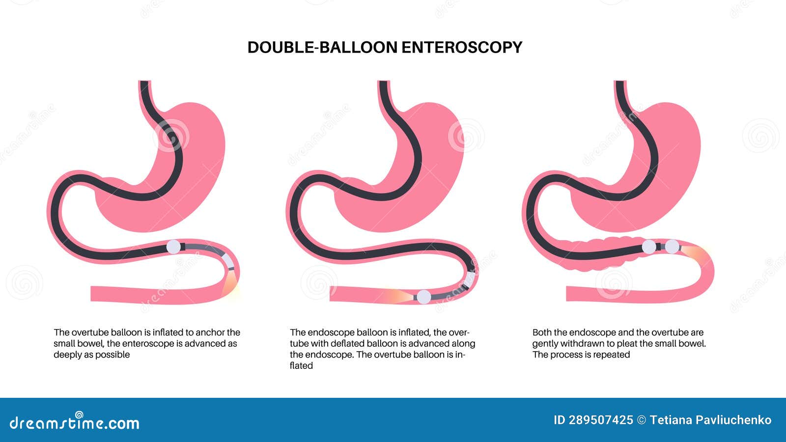 Double balloon enteroscopy stock vector. Illustration of treatment ...