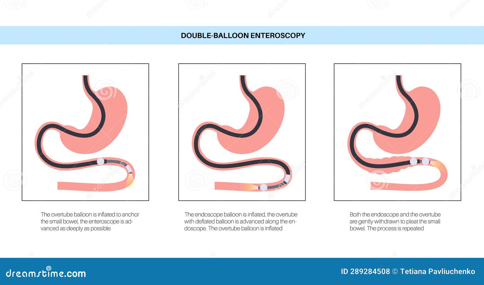 Double balloon enteroscopy stock illustration. Illustration of inflated ...
