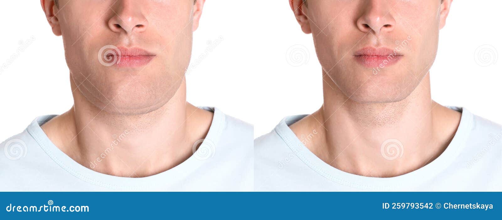 Double Chin Problem. Collage With Photos Of Man Before And After ...
