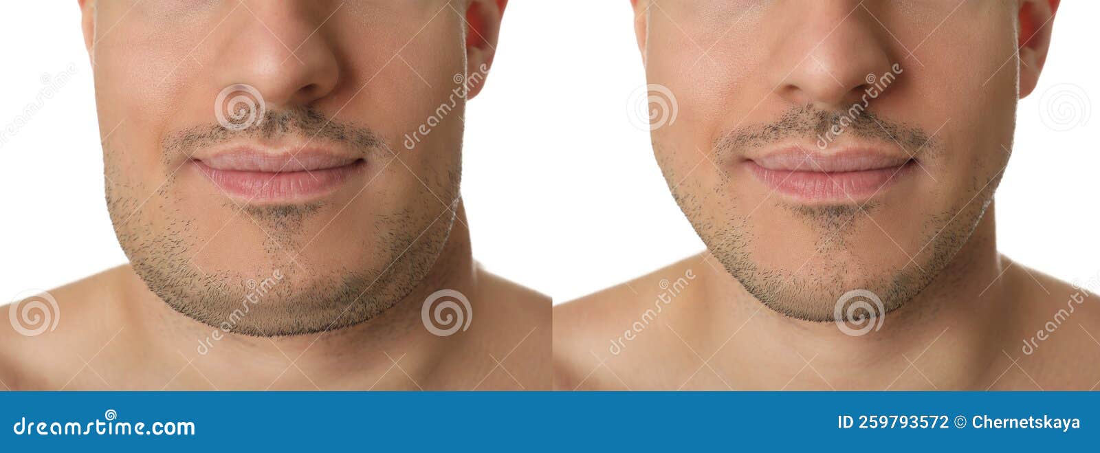 Double Chin Problem. Collage with Photos of Man before and after ...