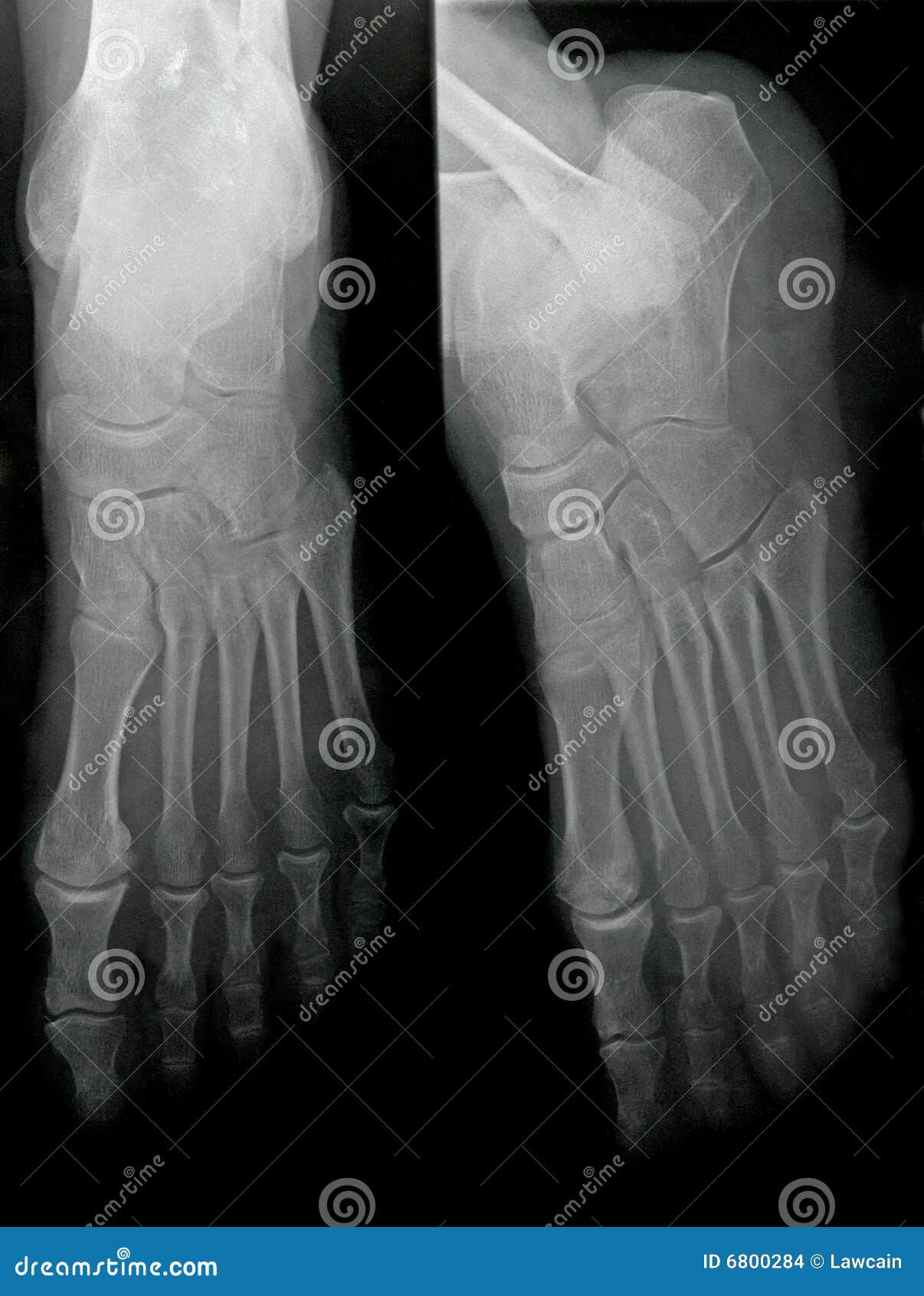 Double Foot X-rays stock photo. Image of humans, calcaneus - 6800284