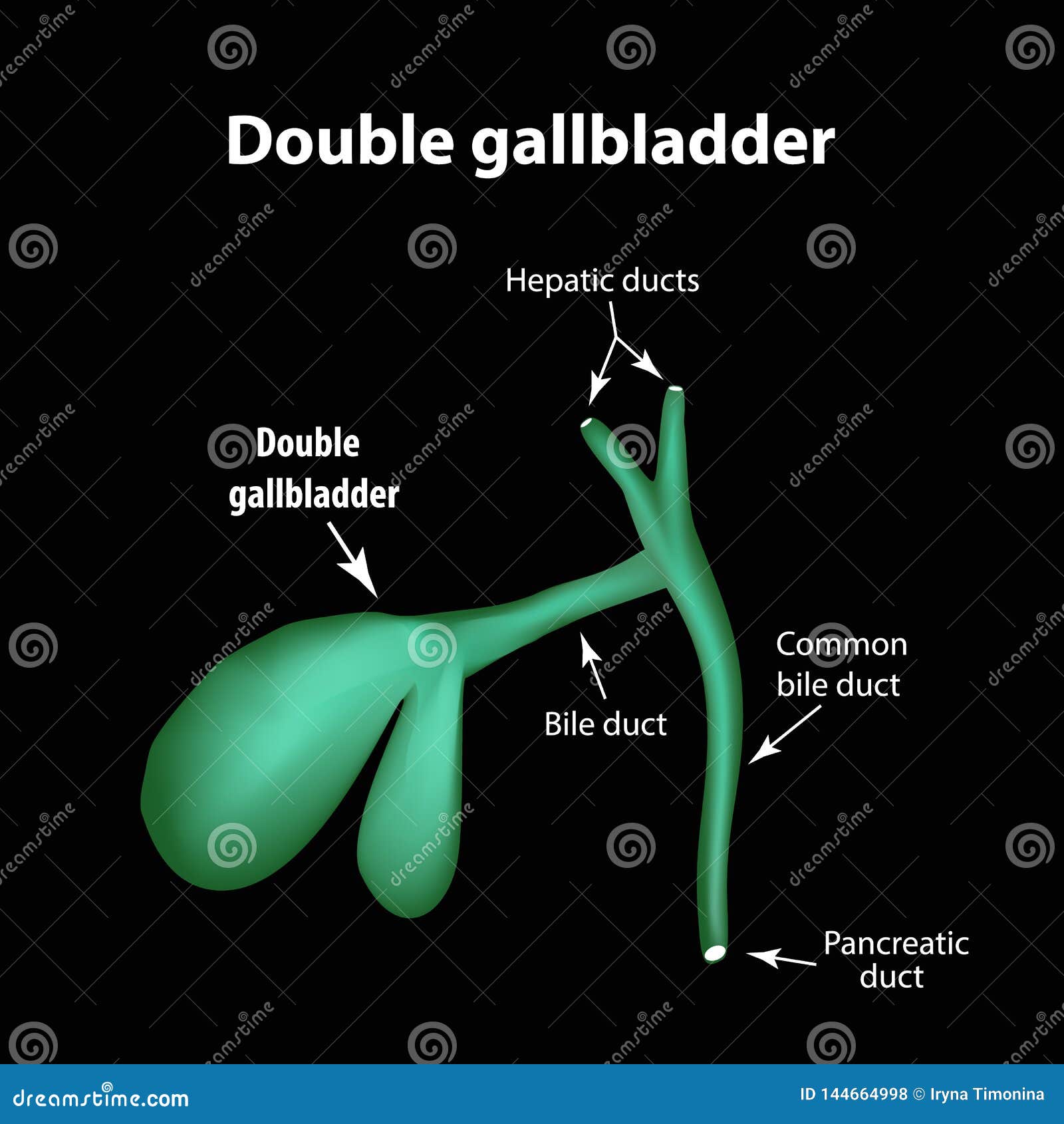 Double Gall Bladder. Pathology of the Gallbladder. Cholecystitis. the ...