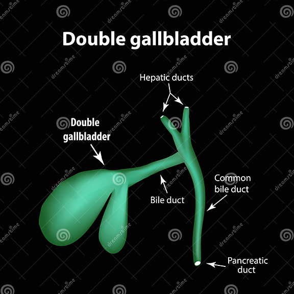 Double Gall Bladder. Pathology of the Gallbladder. Cholecystitis. the ...