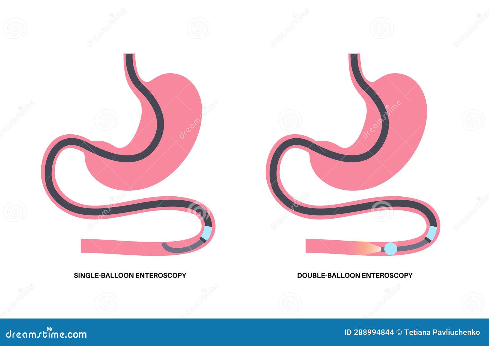 Balloon Assisted Enteroscopy Stock Vector - Illustration of single ...