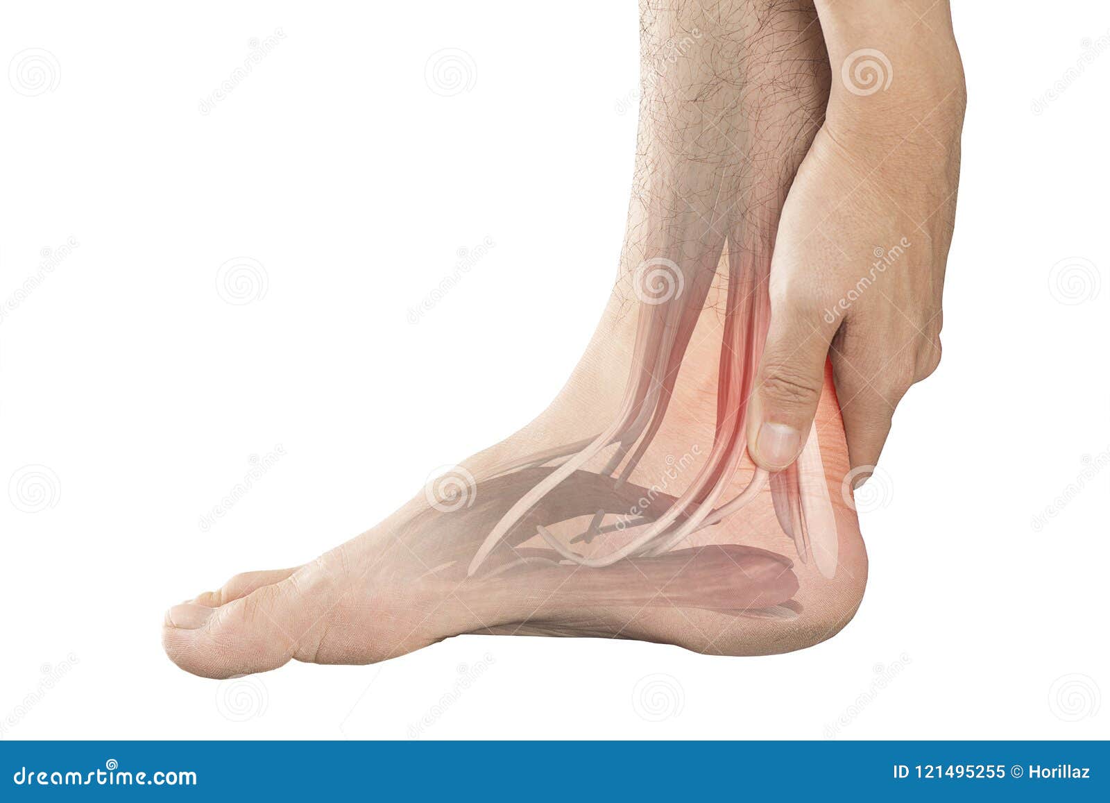 Douleur Musculaire De Talon Image stock - Image du métatarsien, houle ...