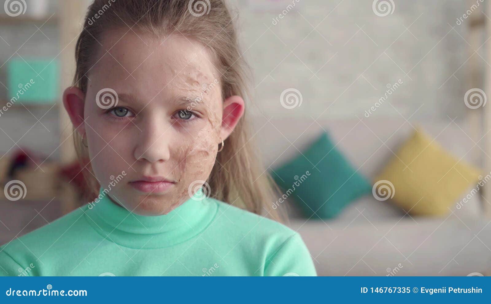 Dramatic Shot Portrait of a Sad, Tired Girl with a Defect or a Burned ...