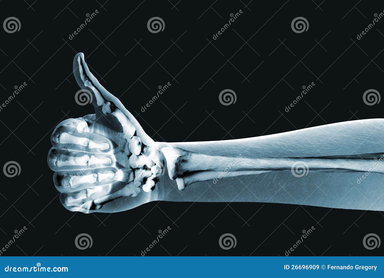 Dramatisierter X-Strahl Einer Hand Greift Oben Ab Stockbild - Bild von ...