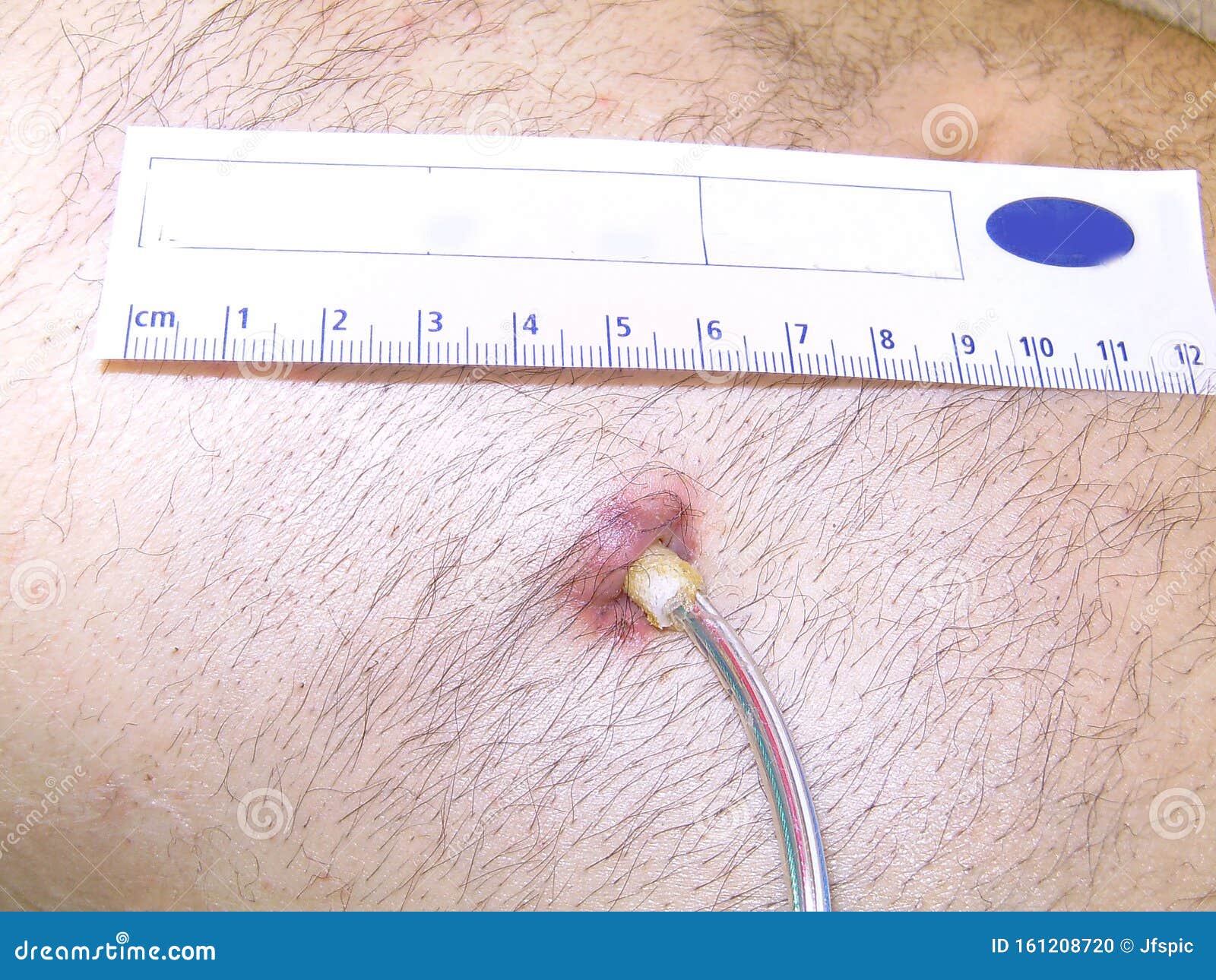 Dressing Driveline Vad System Stock Photo - Image of tzungssystem ...