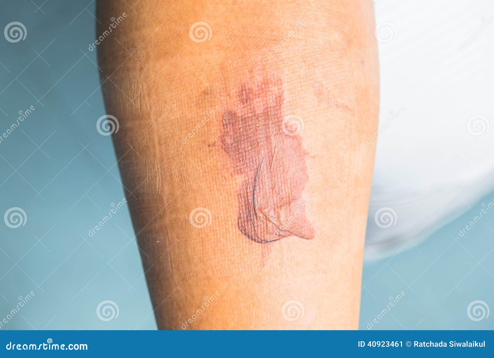 Dressing on leg stock image. Image of human, inability - 40923461