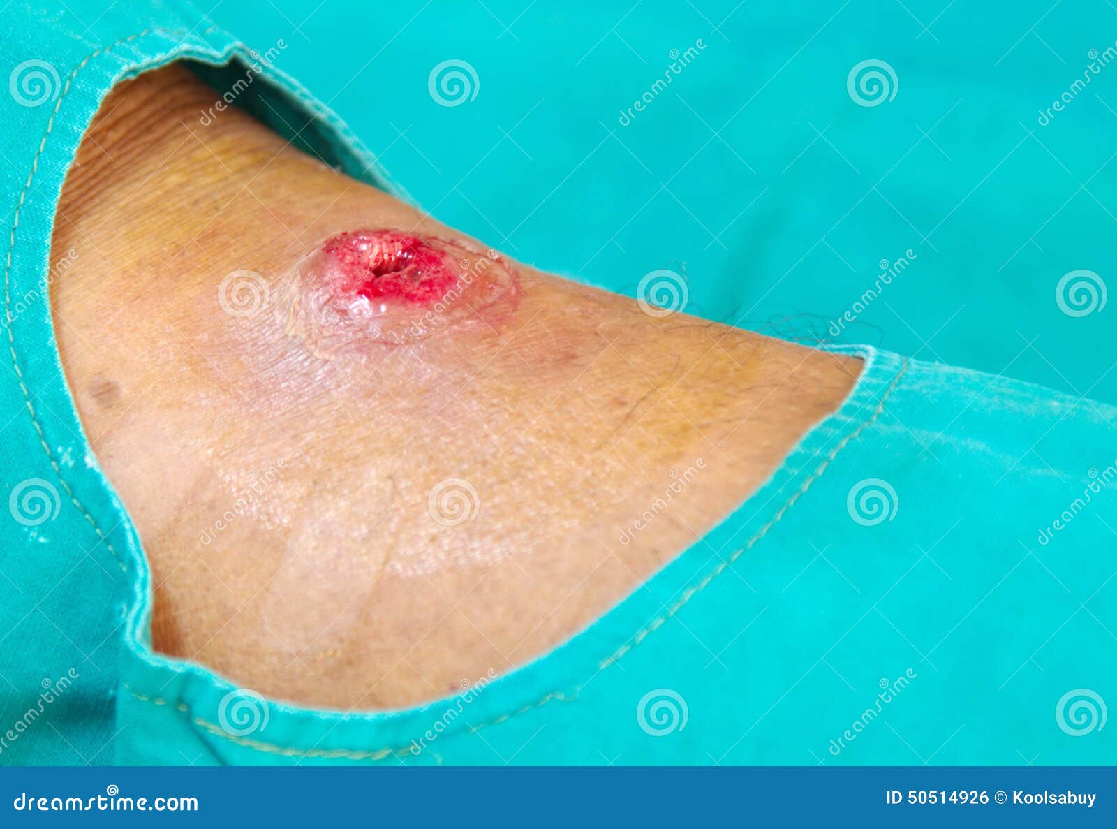 Dressing wound abscess stock photo. Image of closeup - 50514926